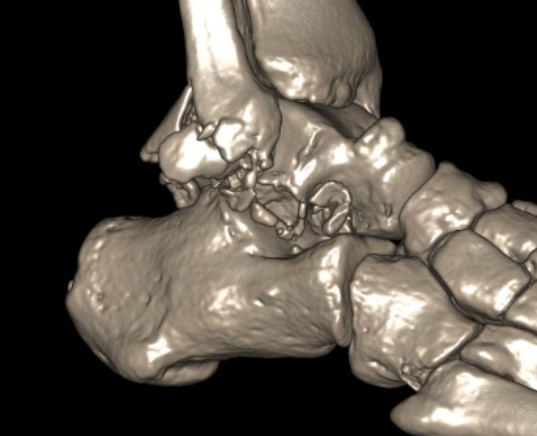 Subtalar Dislocation | The Bone School